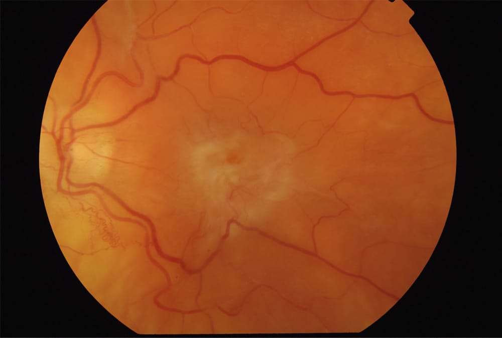 Epiretinal Membrane – A Practical Review - mivision