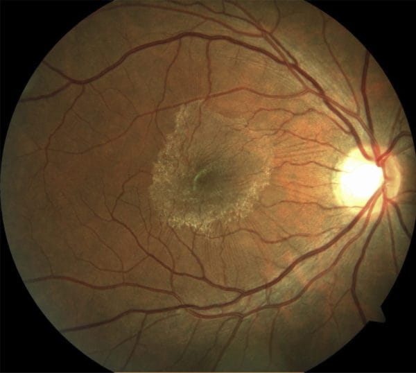 Epiretinal Membrane – A Practical Review - mivision