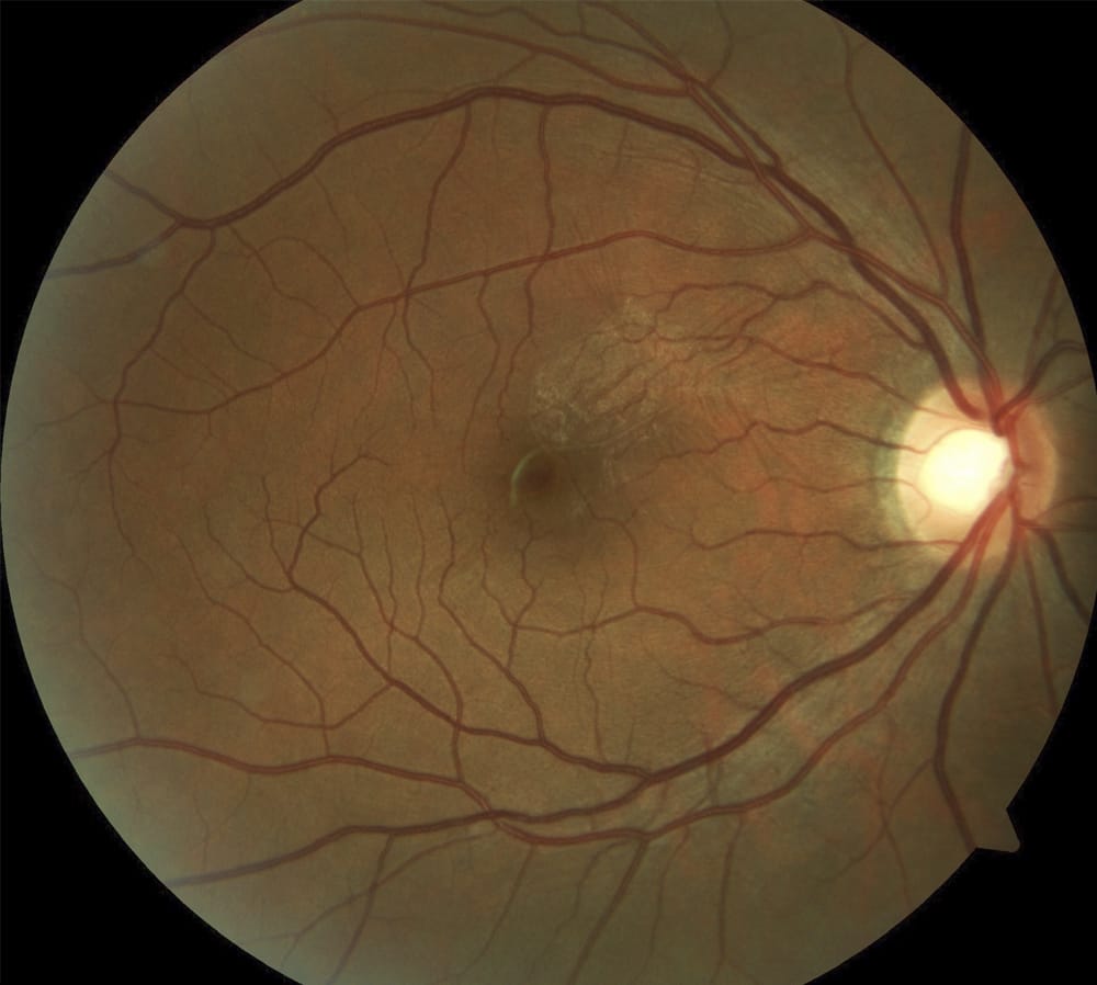 Epiretinal Membrane – A Practical Review - mivision