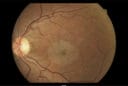 Epiretinal Membrane – A Practical Review - mivision