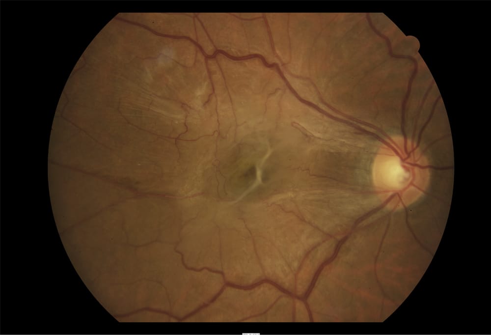 Epiretinal Membrane – A Practical Review - mivision