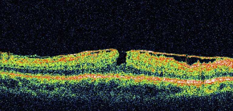 Epiretinal Membrane – A Practical Review - mivision