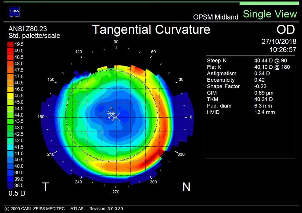 Post-LASIK Myopia & OK: A Case Study - mivision