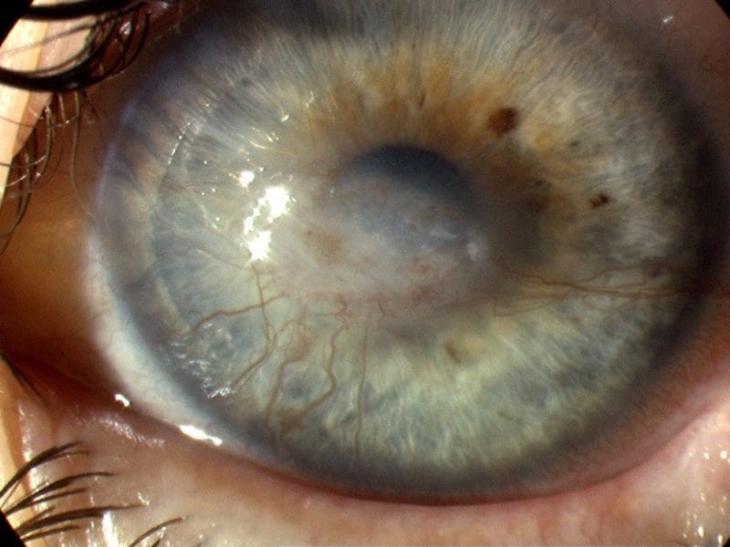 Herpes Simplex Keratitis Guide to Diagnosis and Treatment - mivision