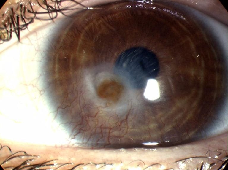 Herpes Simplex Keratitis Guide to Diagnosis and Treatment - mivision