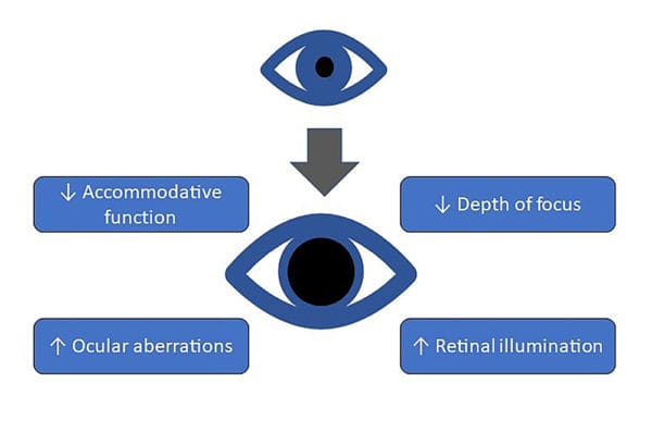 Visual Field Testing Is Pupil Dilation a Compromise? - mivision