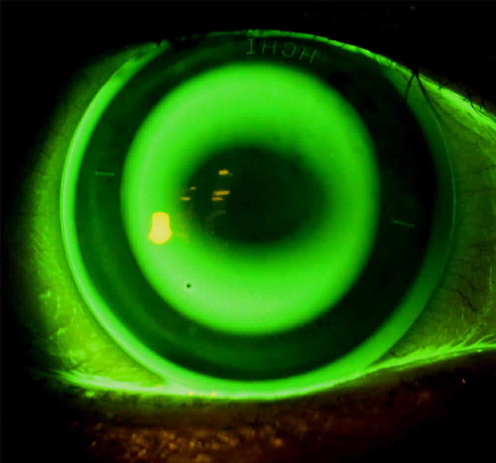 Beware the Adult Myopic Astigmat - mivision
