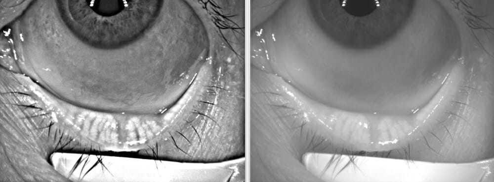 Chronic Dry Eye Disease: From Basic Treatments to the Big Guns - mivision