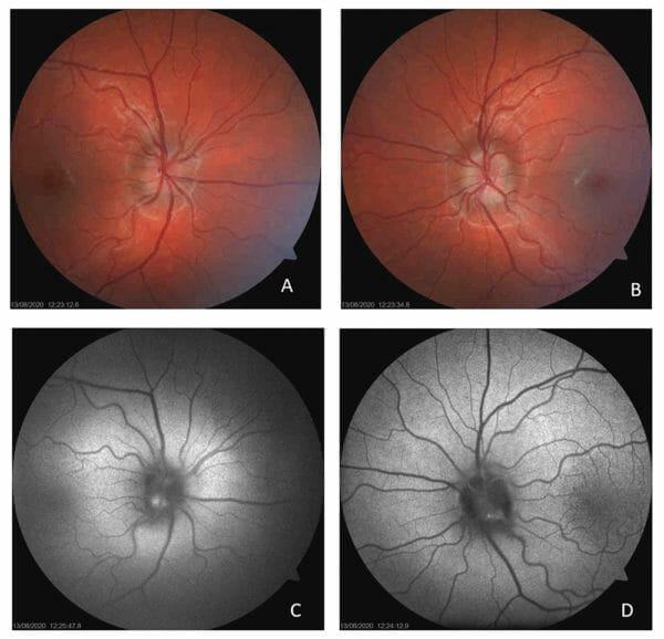 Assessing and Diagnosing the Paediatric Optic Disc - mivision