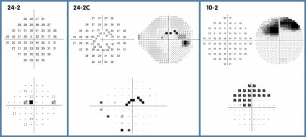 24-2C Visual Field Testing: Glaucoma Management’s Paradigm Shift ...