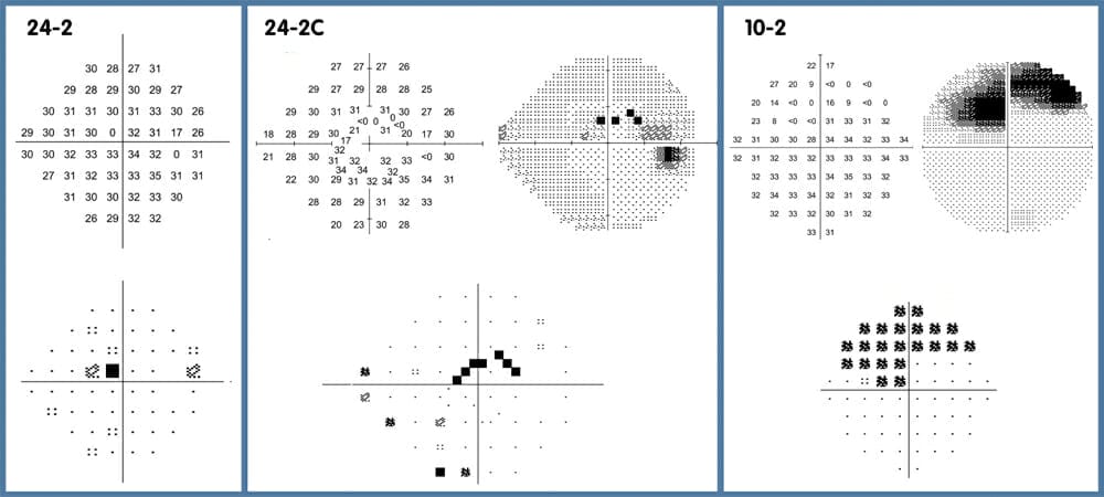 24-2C Visual Field Testing: Glaucoma Management’s Paradigm Shift ...