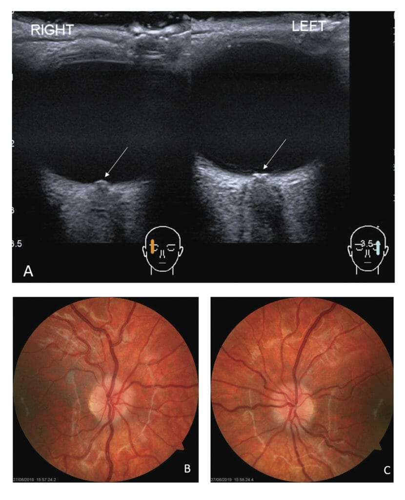 Assessing and Diagnosing the Paediatric Optic Disc - mivision