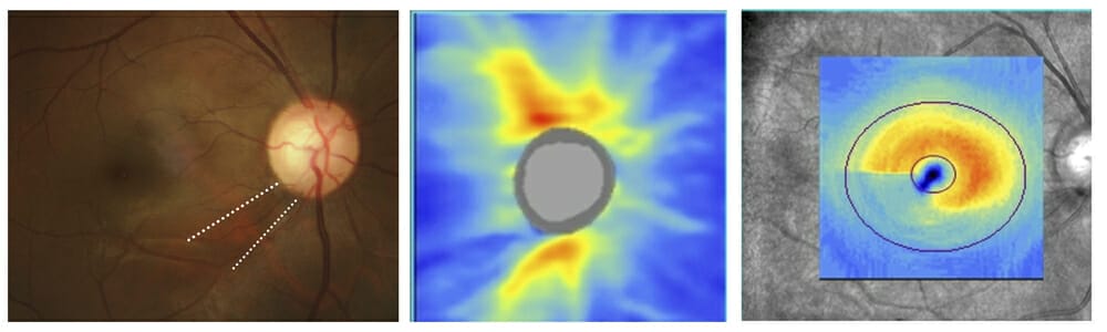 24-2C Visual Field Testing: Glaucoma Management’s Paradigm Shift ...