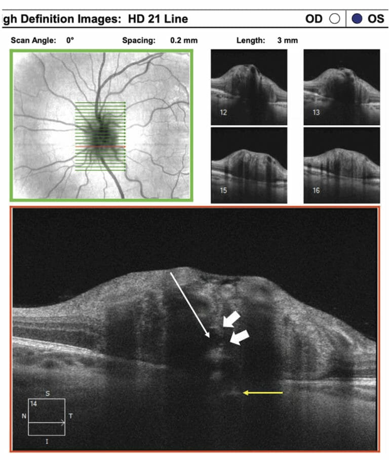 Assessing and Diagnosing the Paediatric Optic Disc - mivision