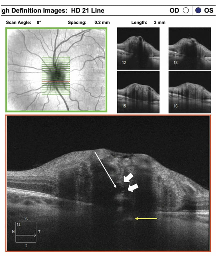 Assessing and Diagnosing the Paediatric Optic Disc - mivision