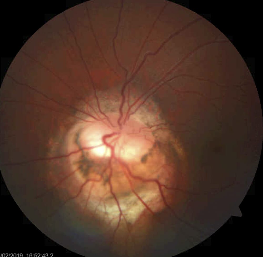 Assessing and Diagnosing the Paediatric Optic Disc - mivision