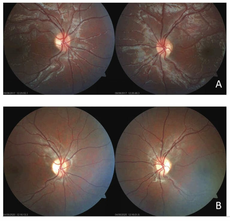 Assessing and Diagnosing the Paediatric Optic Disc - mivision