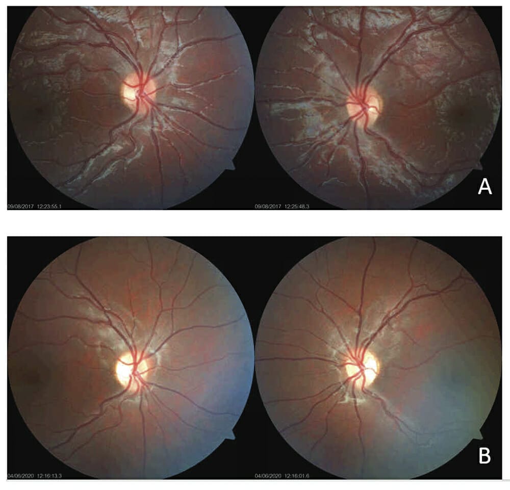 Assessing and Diagnosing the Paediatric Optic Disc - mivision