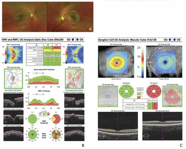 Assessing and Diagnosing the Paediatric Optic Disc - mivision