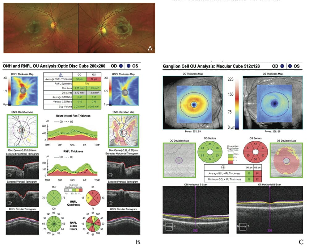 Assessing and Diagnosing the Paediatric Optic Disc - mivision