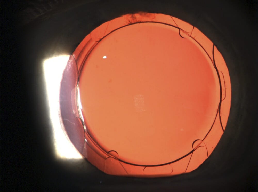 Cataract Surgery: Evaluating Evolving Technologies - mivision