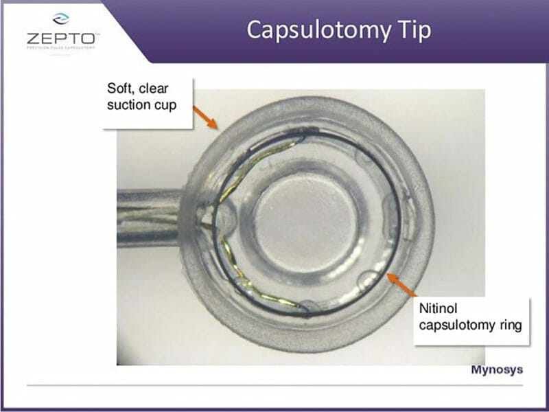 Cataract Surgery: Evaluating Evolving Technologies - mivision