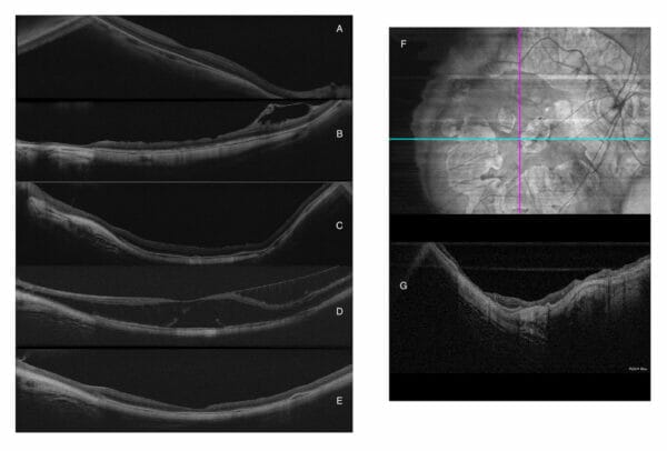 Myopic Retinal Degeneration: Observations with OCT - mivision