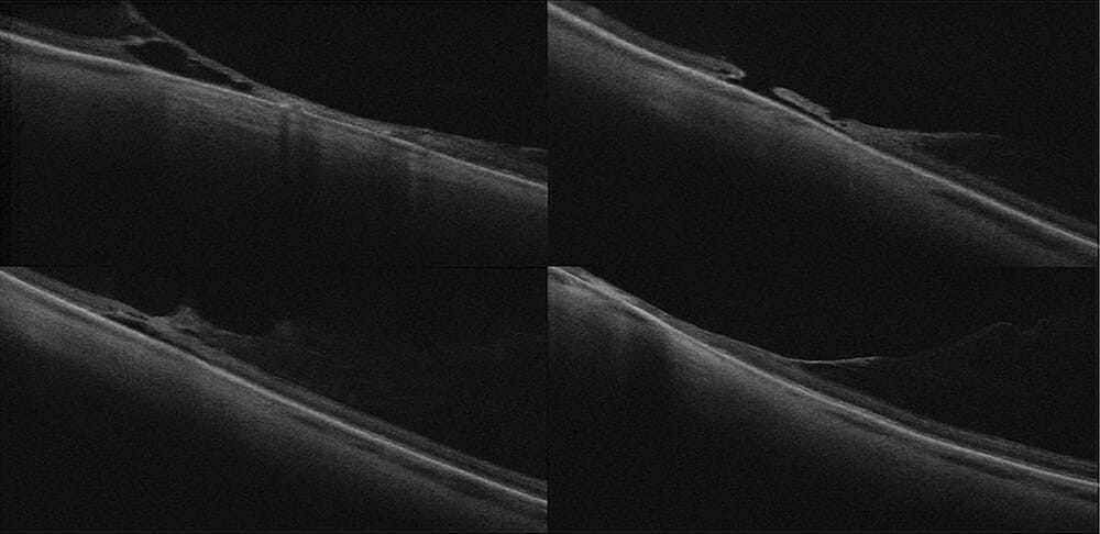 Myopic Retinal Degeneration: Observations with OCT - mivision