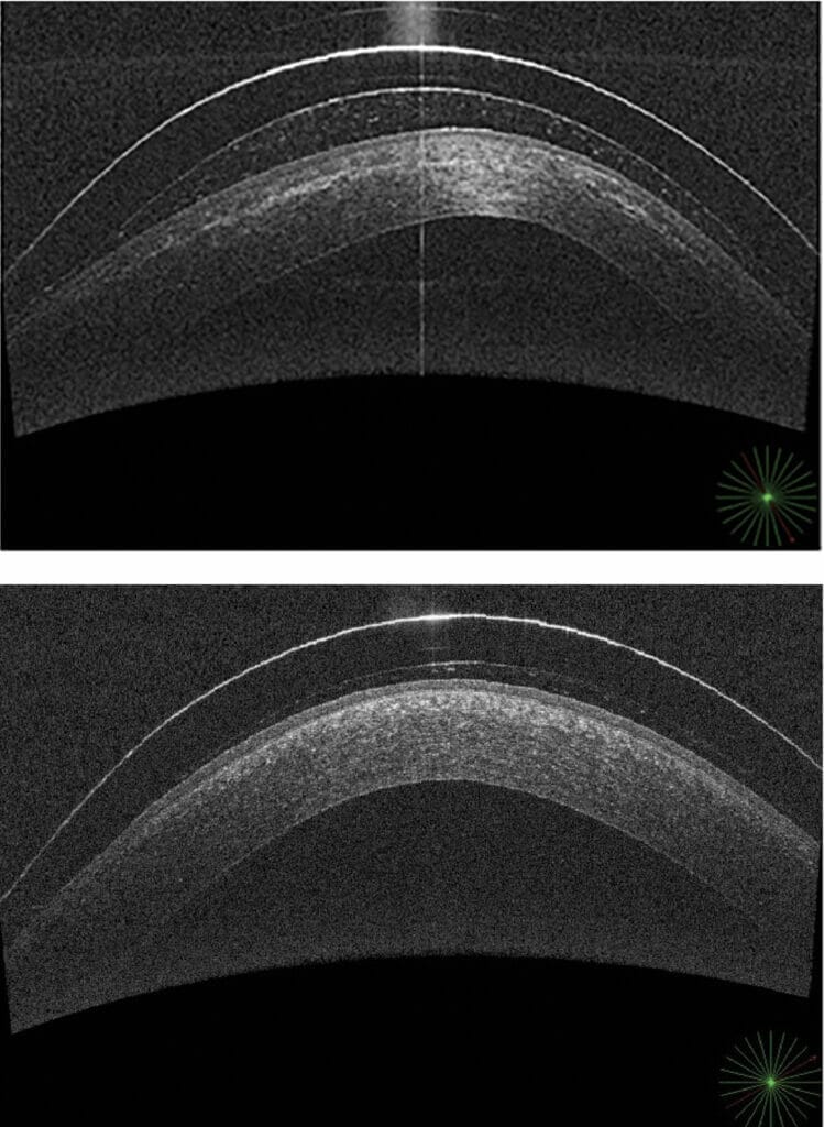 Anterior Segment OCT in a Specialty Contact Lens Practice - mivision