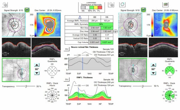 Giant Cell Arteritis: Detection and Management - mivision