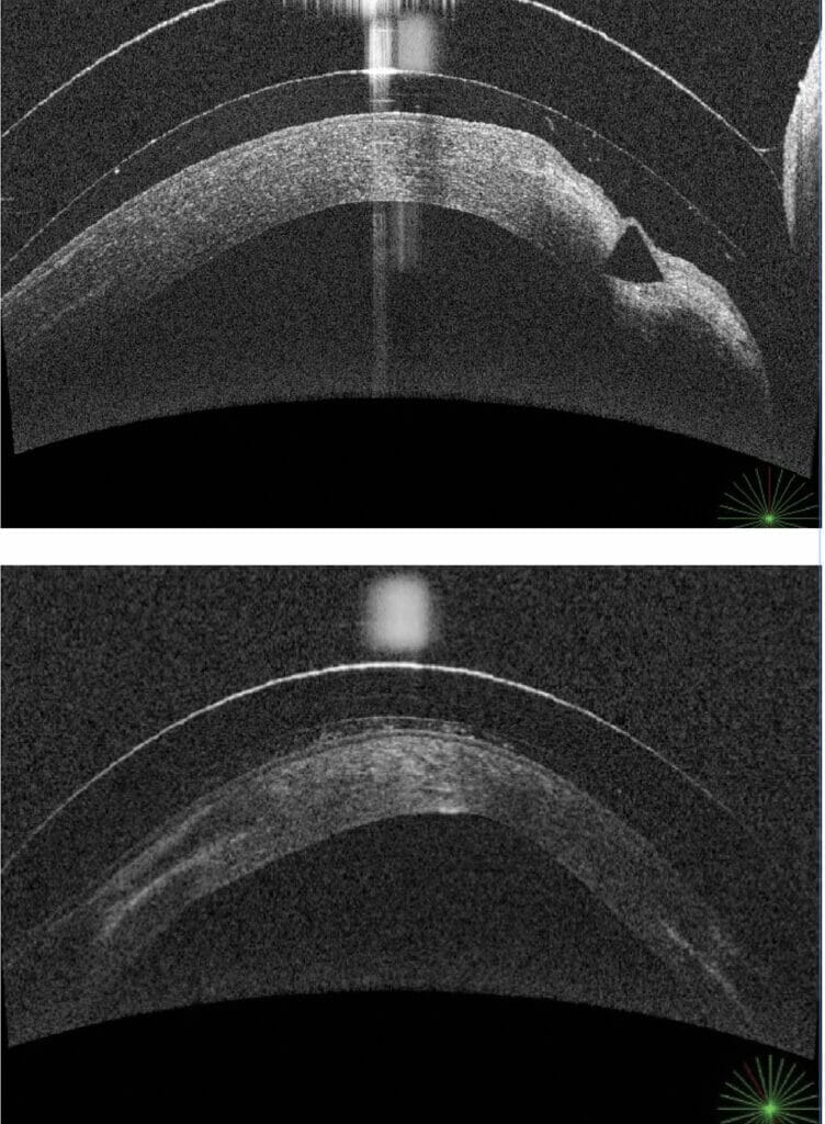 Anterior Segment OCT in a Specialty Contact Lens Practice - mivision