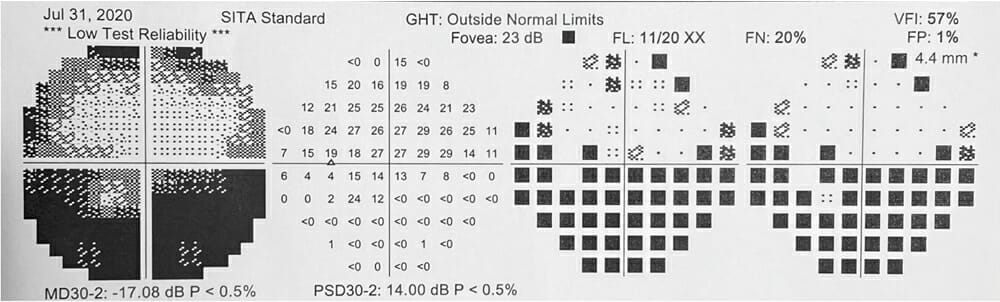 Giant Cell Arteritis: Detection and Management - mivision