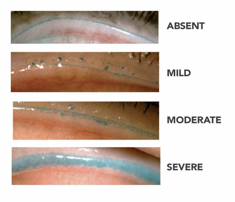 Dry Eye in Clinical Practice Filling in the Gaps - mivision