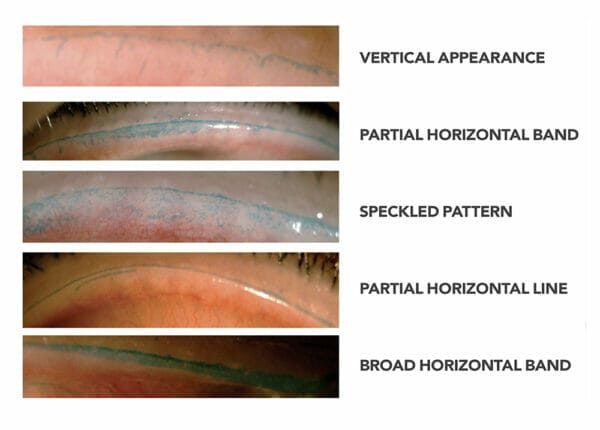 Dry Eye in Clinical Practice Filling in the Gaps - mivision