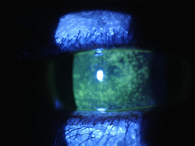 Amniotic Membranes and Ocular Surface Repair – the New Frontier - mivision
