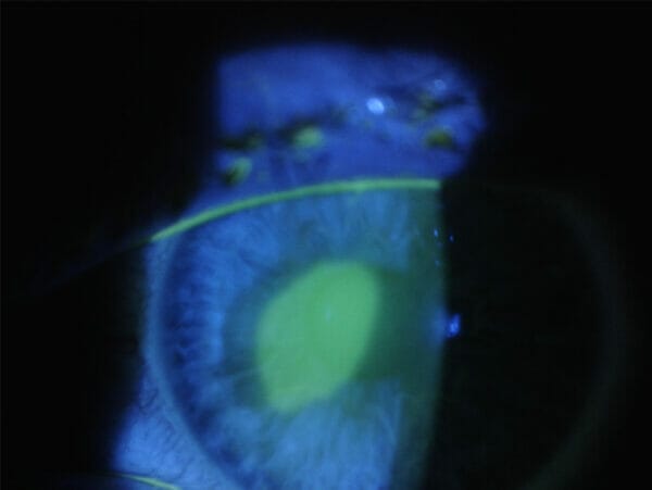 Amniotic Membranes and Ocular Surface Repair – the New Frontier - mivision