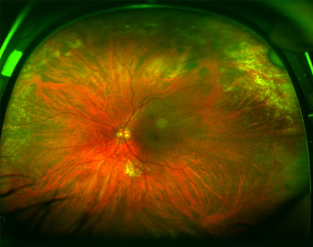 Cataract Surgery in Patients with Retinal Disease: A Practical Review ...