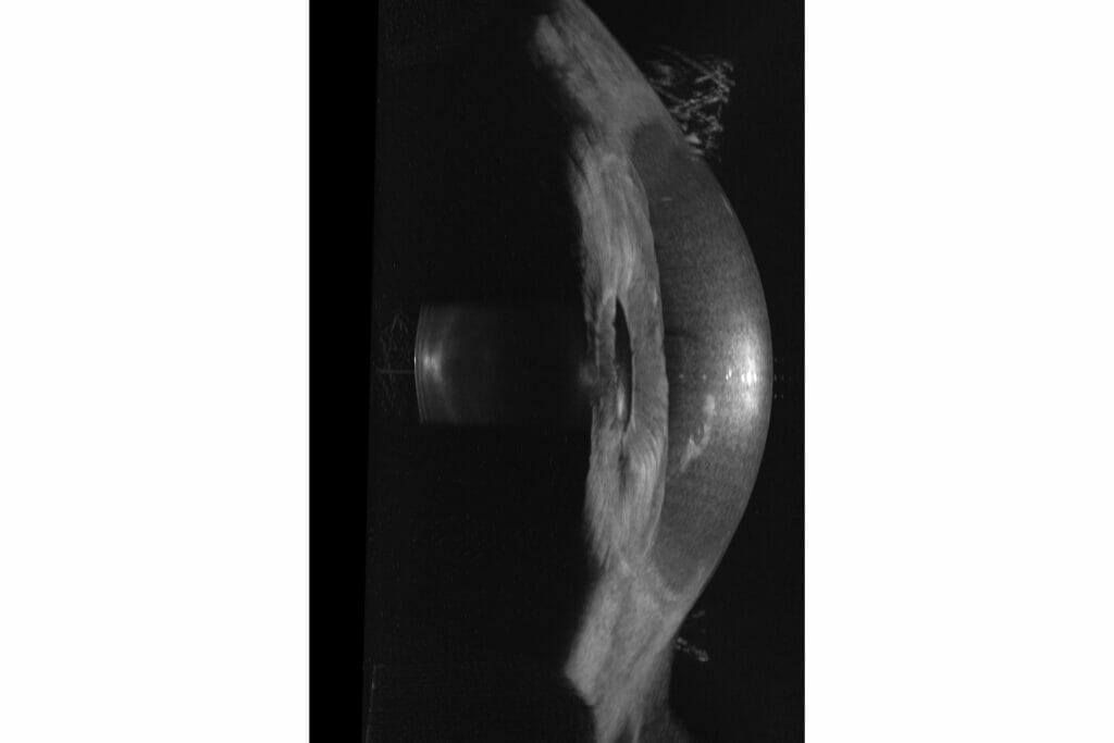 Cataract and the HP-OCT - mivision