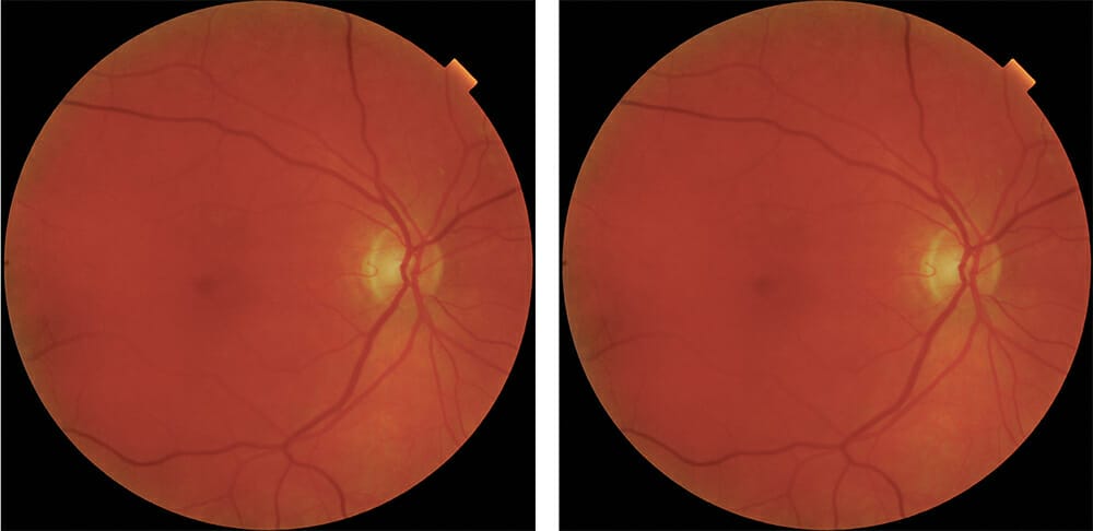 Saving Sally: A Case of Plaquenil Retinopathy - mivision