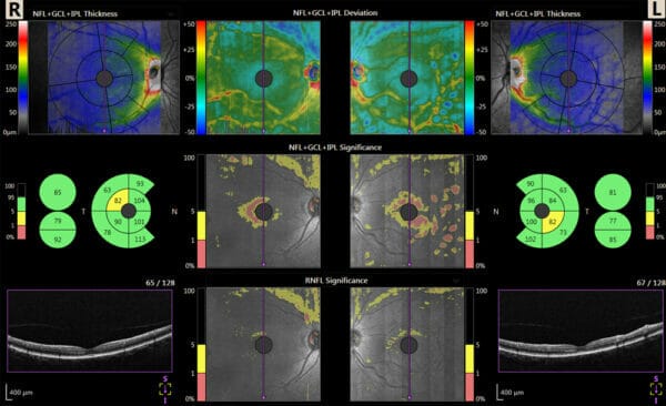 Saving Sally: A Case of Plaquenil Retinopathy - mivision
