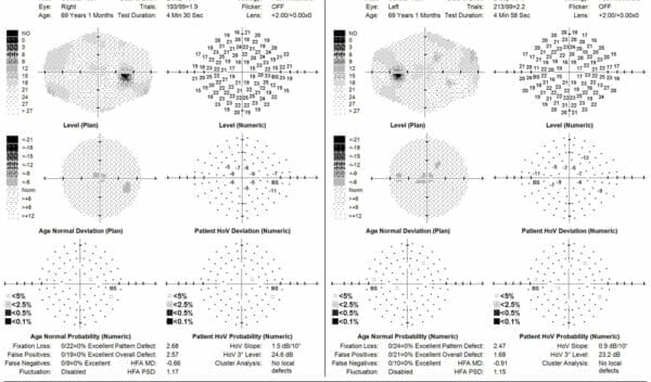 Saving Sally: A Case of Plaquenil Retinopathy - mivision