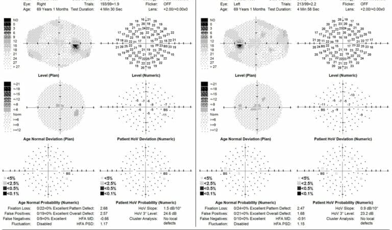 Saving Sally: A Case of Plaquenil Retinopathy - mivision