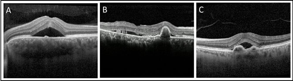 Macular Subretinal Fluid A Diagnostic Approach - mivision