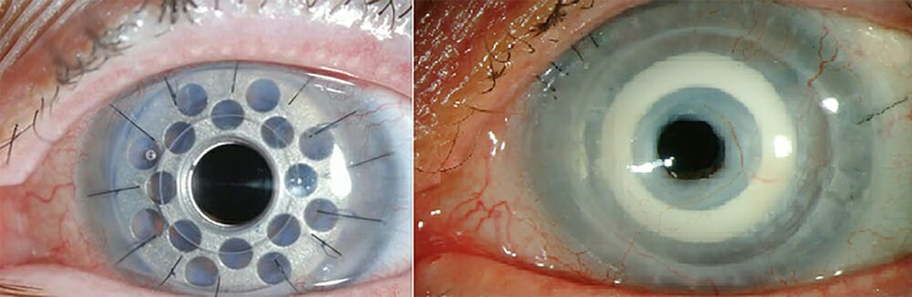 Corneal Bioengineering Advances in 2021 - mivision
