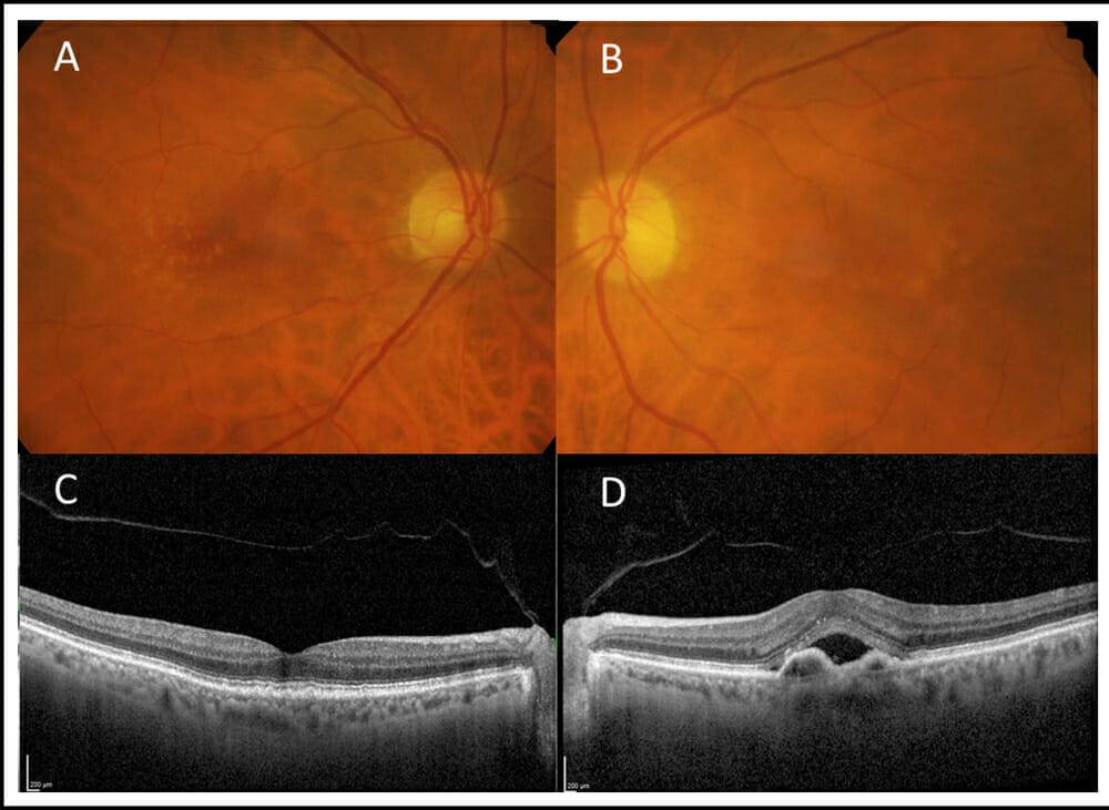 Macular Subretinal Fluid A Diagnostic Approach - mivision
