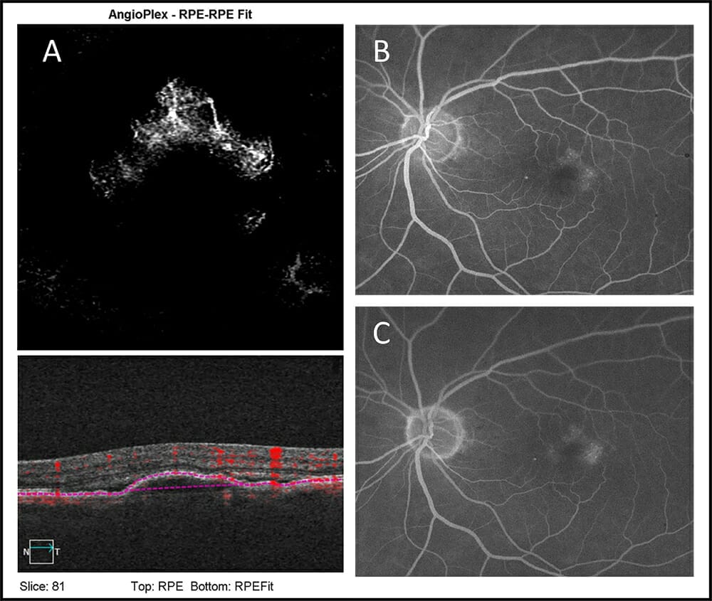 Macular Subretinal Fluid A Diagnostic Approach - mivision