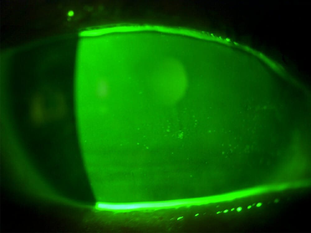 Amniotic Membranes and Ocular Surface Repair: Part 2 - mivision