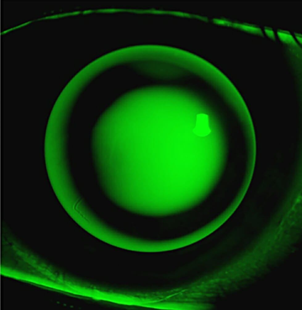 Managing Keratoconus Rigid Contact Lens Options - mivision