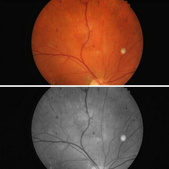 Six Tips for Detecting Proliferative Diabetic Retinopathy - mivision