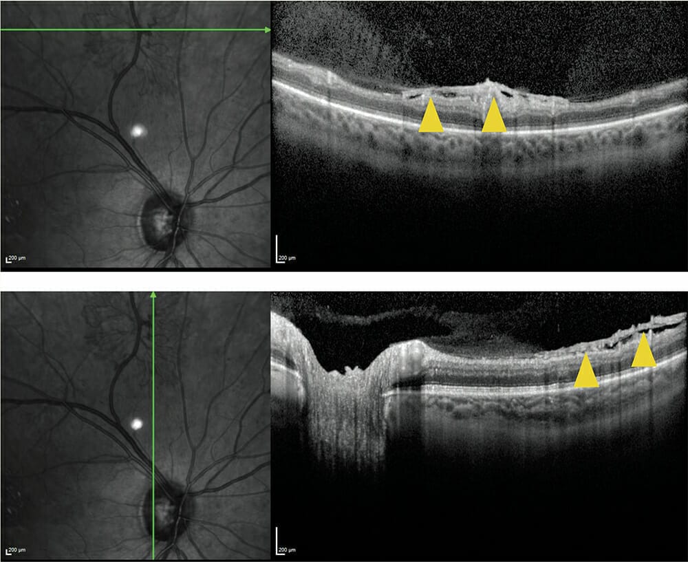 Six Tips for Detecting Proliferative Diabetic Retinopathy - mivision